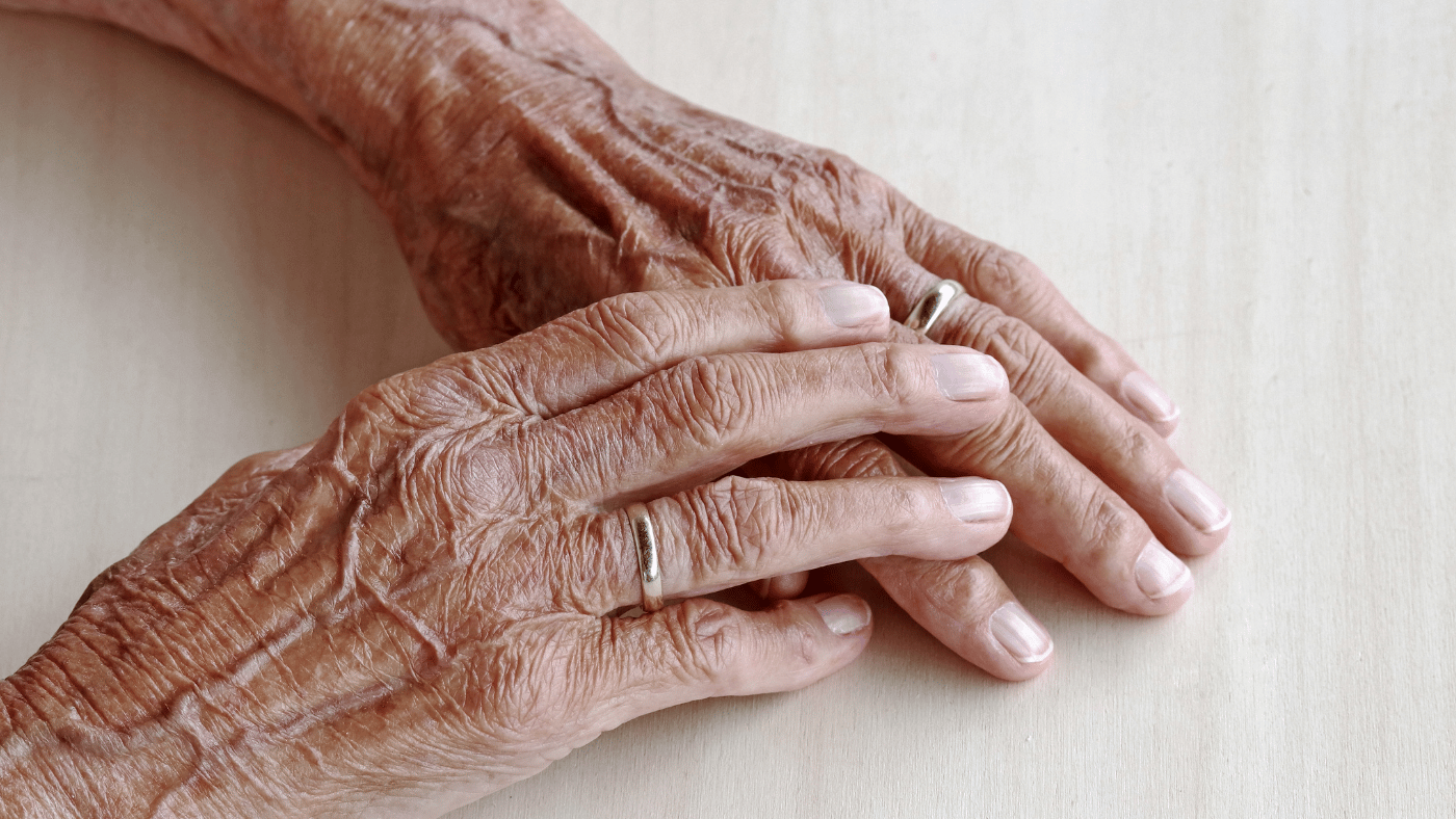 Hand Rejuvenation Treatments in Altrincham | Dr Ed Robinson