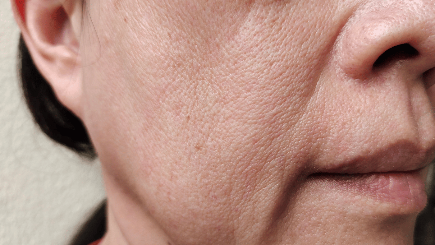 Sagging Skin Treatments Manchester | Tighten Skin | Dr Ed